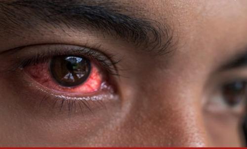 Pink eyes: The causes and how to prevent it | Bona Magazine