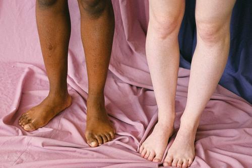 This is what causes dark spots on your legs | Bona Magazine