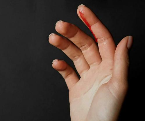 World Haemophilia Day: Understanding the disease and treatment ...